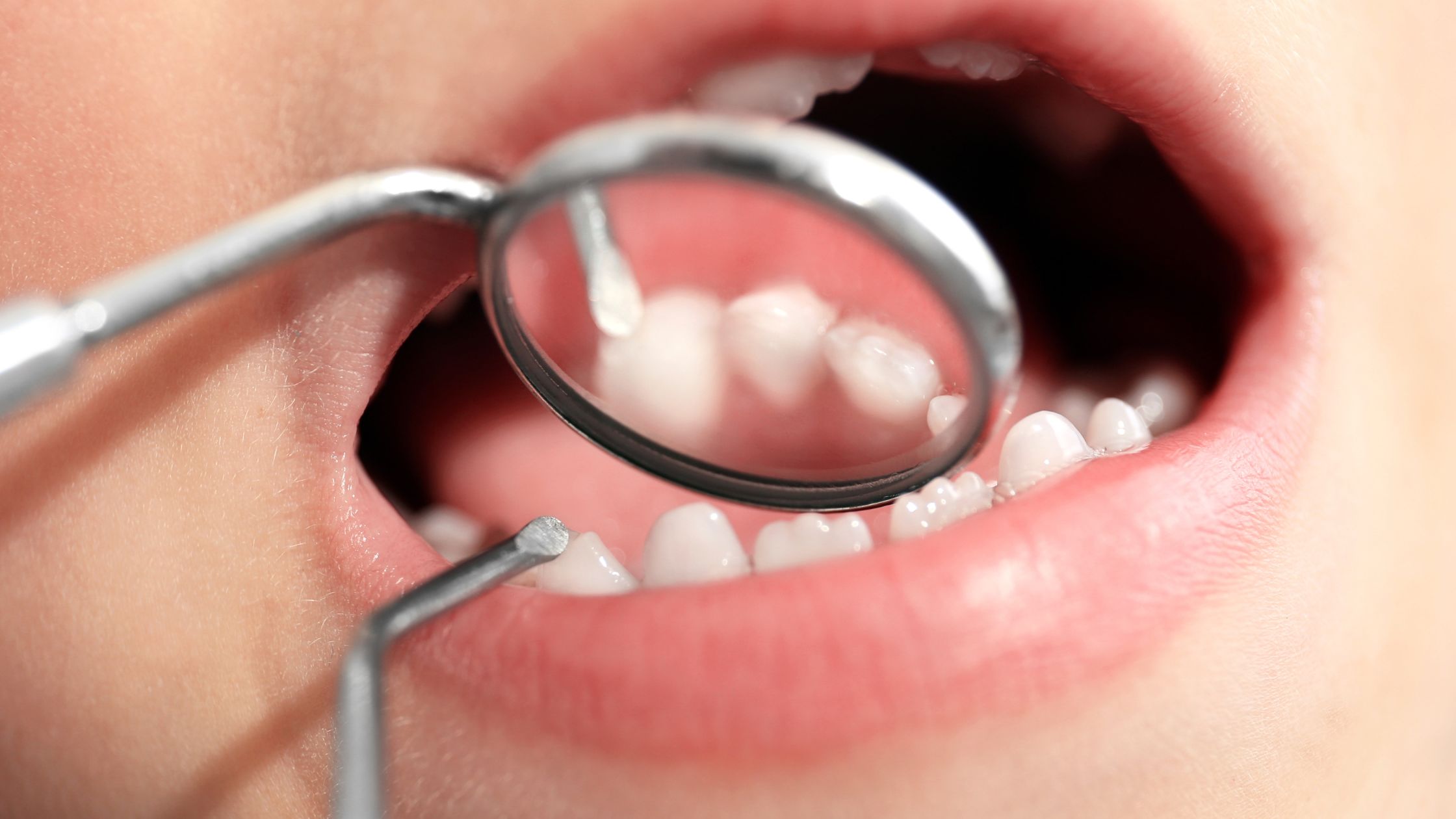 Caries dental prevención y tratamiento en la infancia